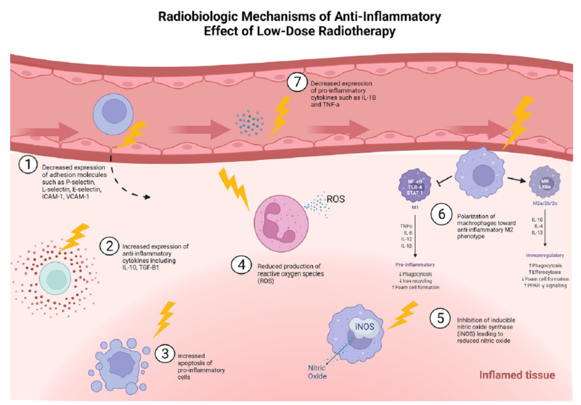 Low Dose Radiation Therapy for Osteoarthritis | IORBC